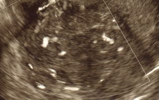 Uterine Fibroids Info | Family Fertility Center | Bethlehem PA